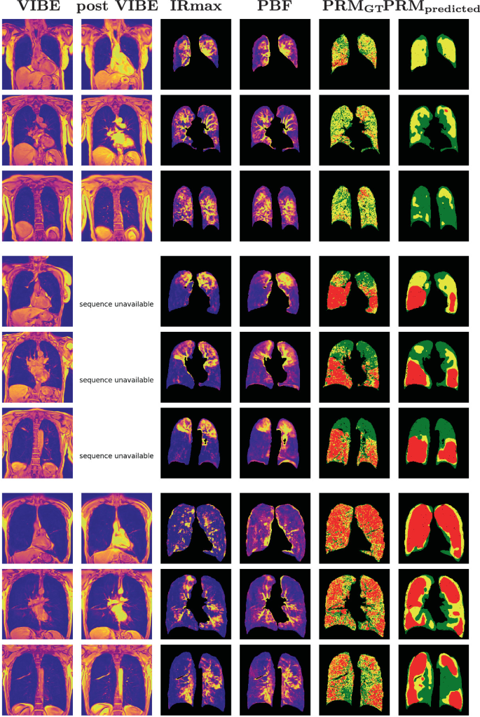 A Learning Framework for Predicting CT-Based PRM Biomarker from MRI ...