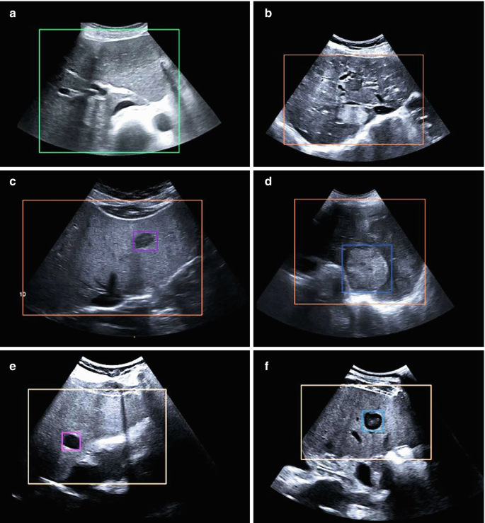 AI Applications in Ultrasound Imaging | Springer Nature Link