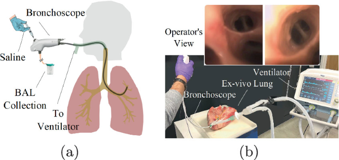 Navigational Bronchoscopy In Critical Care Via End To End Pose