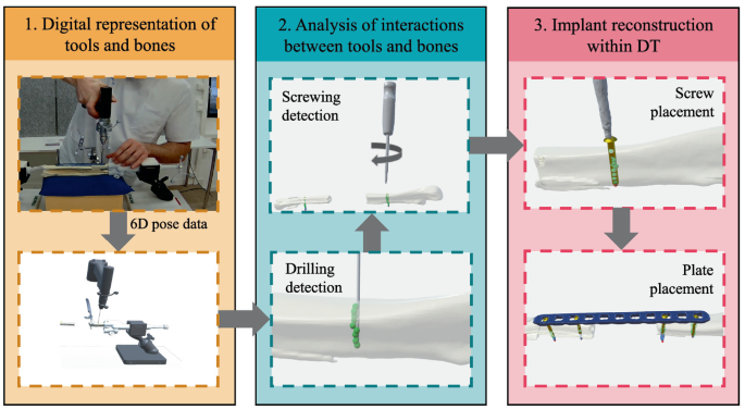 Automated Integration of Surgical Implants Into Digital Twins for ...