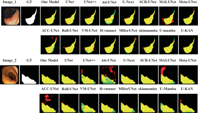 KMUNet: A Novel Medical Image Segmentation Model Based on KAN and Mamba ...