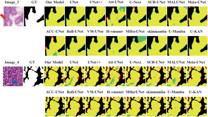 KMUNet: A Novel Medical Image Segmentation Model Based on KAN and Mamba ...