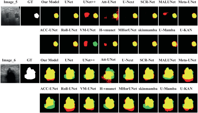 KMUNet: A Novel Medical Image Segmentation Model Based on KAN and Mamba ...