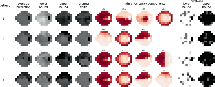 Reliable and Interpretable Visual Field Progression Prediction with ...