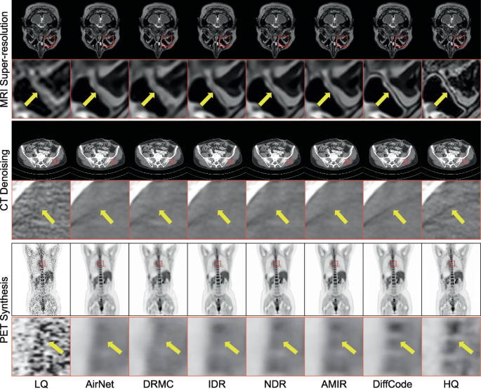 All-in-One Medical Image Restoration with Latent Diffusion-Enhanced ...