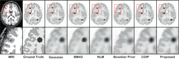 Bowsher Prior Enhanced Unsupervised PET Image Denoising | SpringerLink