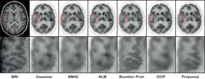 Bowsher Prior Enhanced Unsupervised PET Image Denoising | SpringerLink