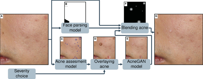 ACNEDIT: Acne Creation and Non-Destructive Editing with Dynamic ...