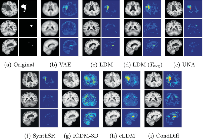Conditional Diffusion Models for Guided Anomaly Detection in Brain MRI Using Fluid-Driven ...