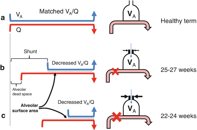 The Neonatal Respiratory System at Critical Extremes | Springer Nature Link