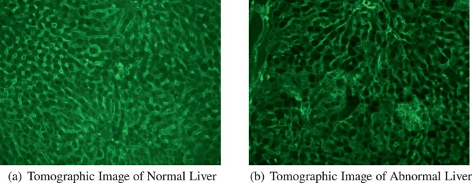 Changes in Capillary Network Structure in Liver Caused by Liver Disease ...