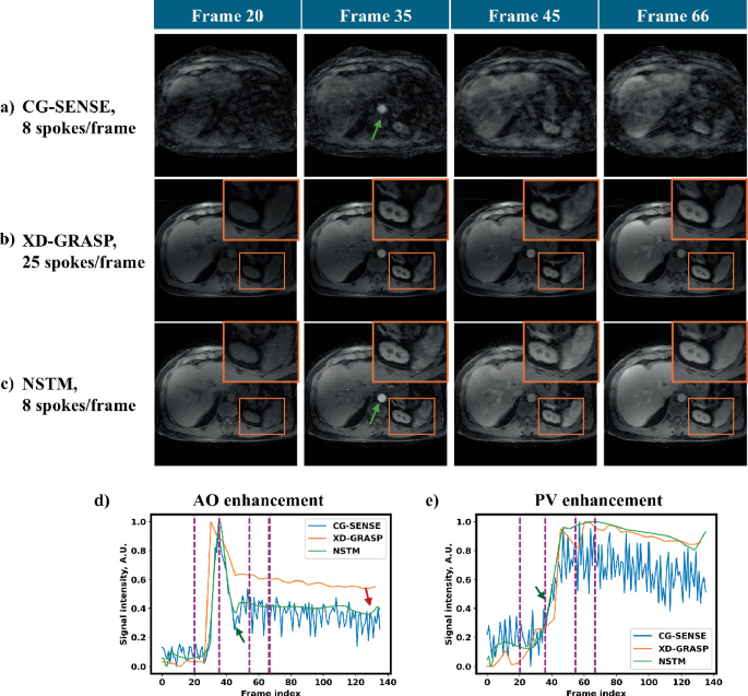 Neural Space-Time Modeling for Motion-Corrected MR Reconstruction ...