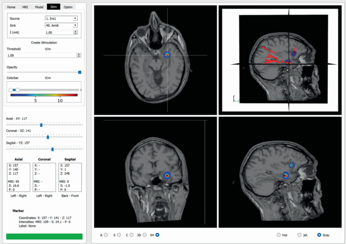 Visualization and Optimization Software for Presurgical Brain ...