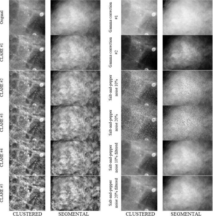 Evaluating Preprocessing Techniques for Calcification Morphology ...