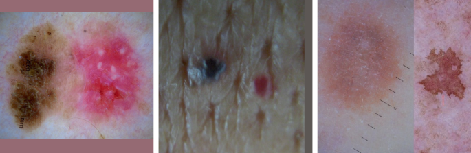 Towards Robust Skin Lesion Classification: Lesion Segmentation, Mole ...