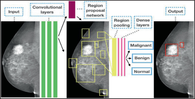 A Hybrid CNN Model for Efficient Breast Cancer Diagnosis Utilizing ...