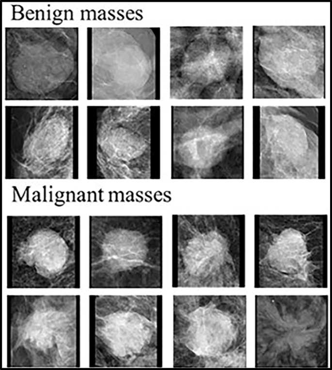 A Hybrid CNN Model for Efficient Breast Cancer Diagnosis Utilizing ...