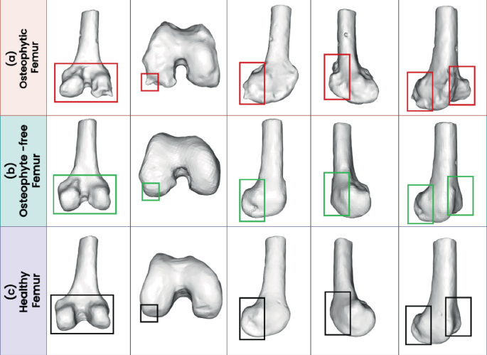 OsteoDeform: Osteophyte-Aware Shape Deformations of Distal Femur Models ...