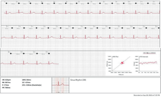 AI in Healthcare Sector: A Systematic Review on the Detection of (HRV ...