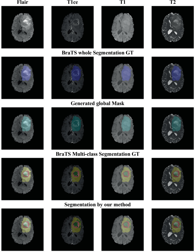 Unsupervised Multi-class Glioma Segmentation in 3D MRI Using Adaptive ...
