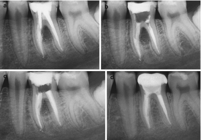 Nonsurgical Root Canal Retreatment | Springer Nature Link (formerly ...