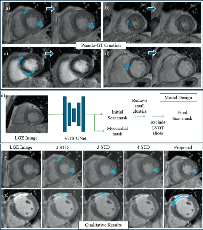 LGE Scar Quantification Using Foundation Models for Cardiac Disease ...