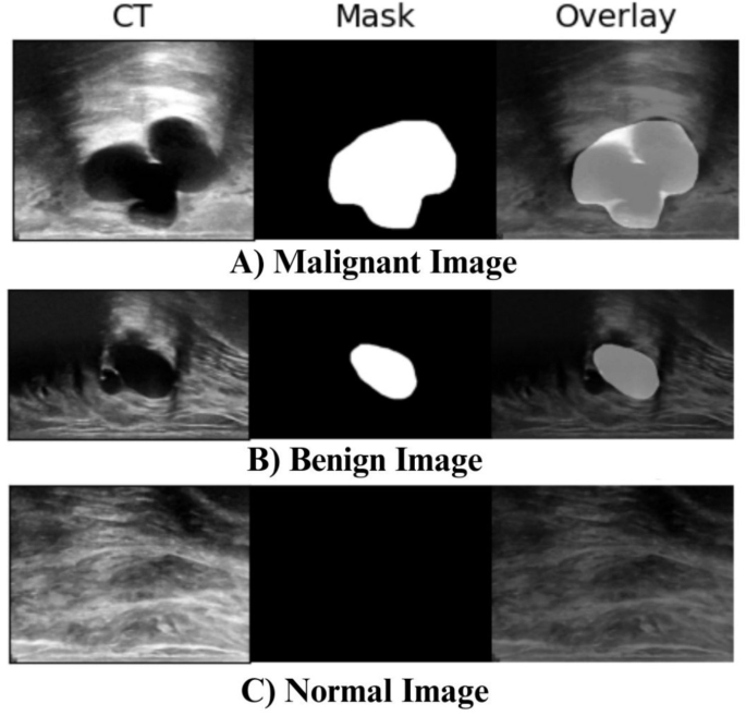 Deep Learning-Based U-Net Enhancement for Breast Cancer Segmentation ...
