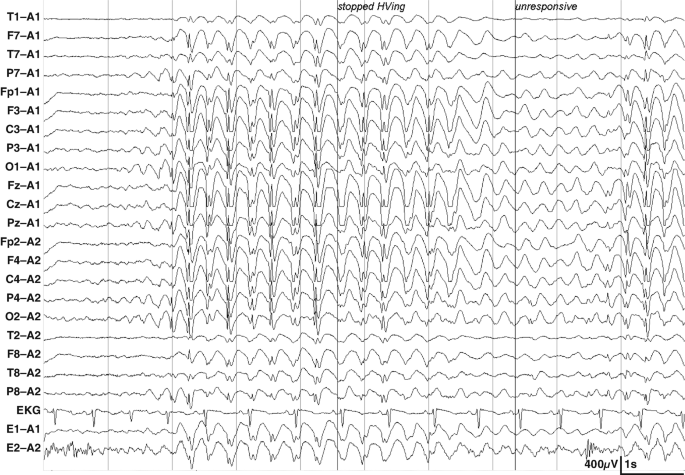 Generalized Epileptiform Discharges and Generalized Epilepsies ...