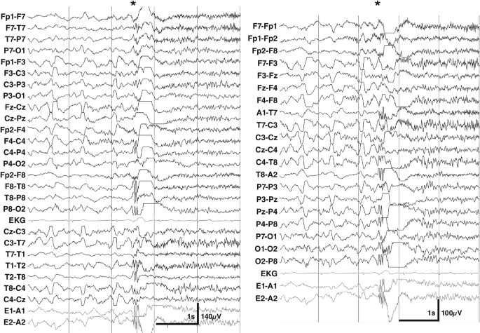 Generalized Epileptiform Discharges and Generalized Epilepsies ...