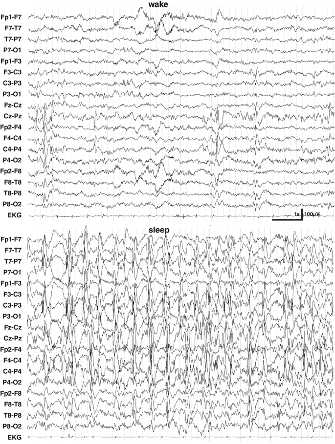 Generalized Epileptiform Discharges and Generalized Epilepsies ...
