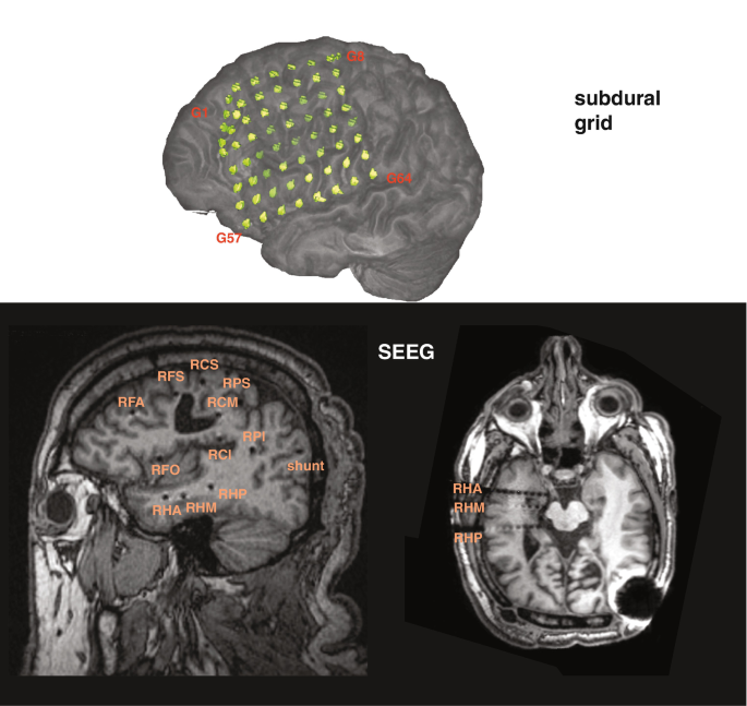 Intracranial Monitoring | SpringerLink