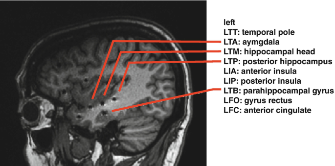 Intracranial Monitoring | SpringerLink