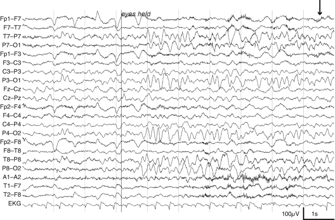 Normal Waking Electroencephalogram | SpringerLink