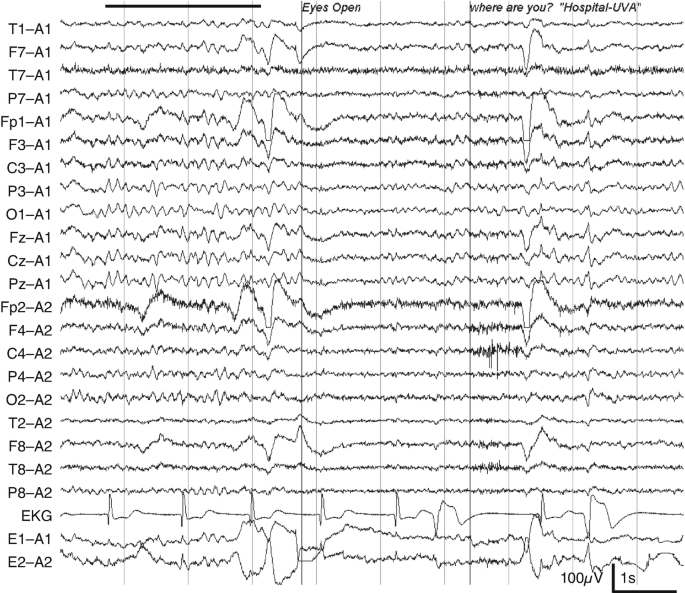 Normal Waking Electroencephalogram | SpringerLink