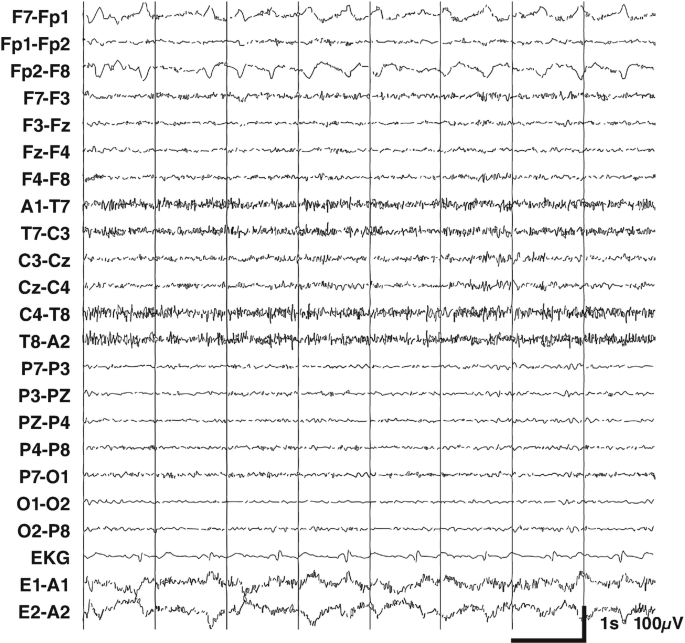 The Electroencephalogram in the Older Adult | Springer Nature Link ...