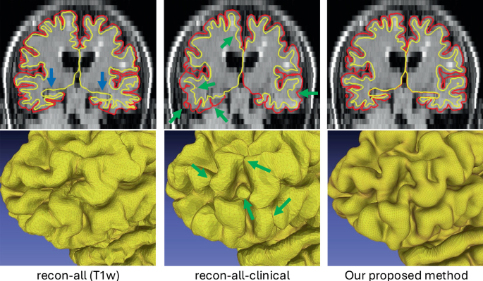 End-to-End Cortical Surface Reconstruction from Clinical Magnetic ...
