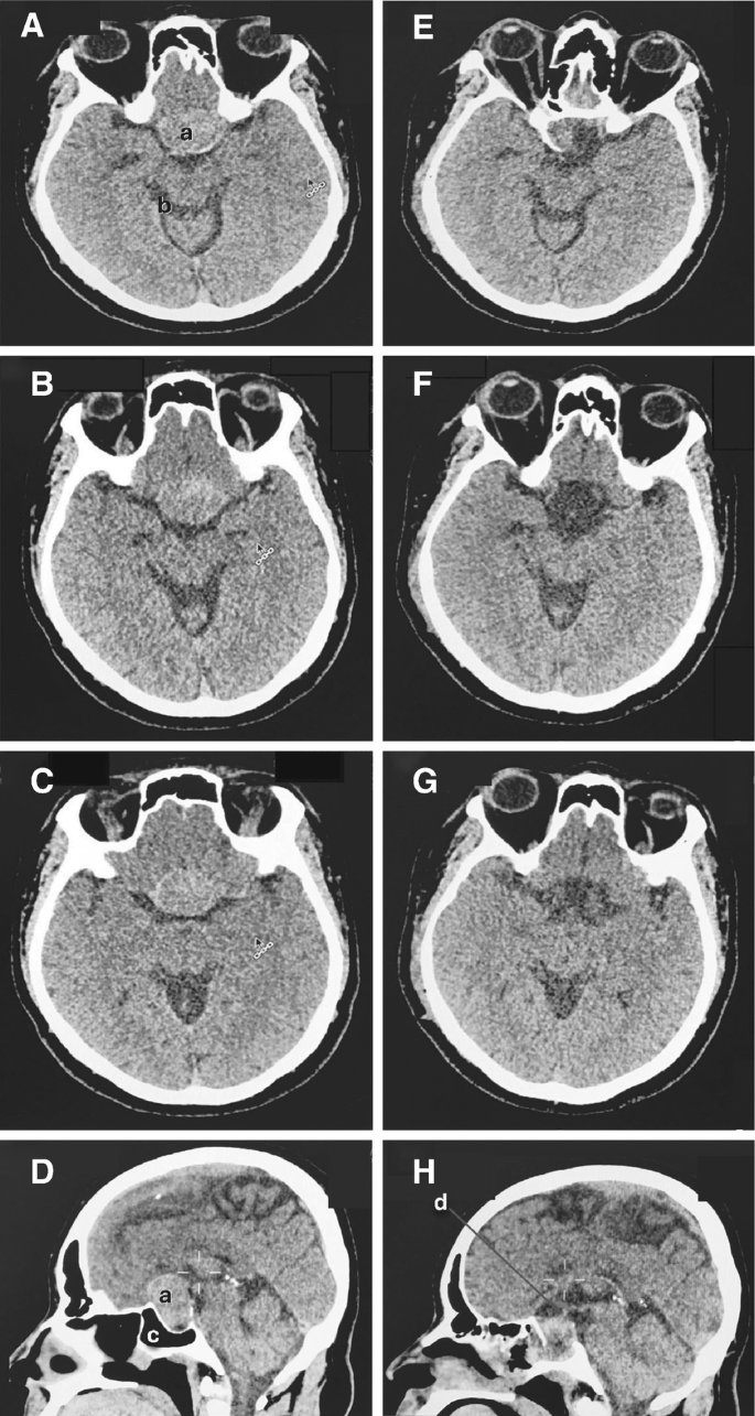 Headache Attributed to Pituitary Apoplexy | Springer Nature Link