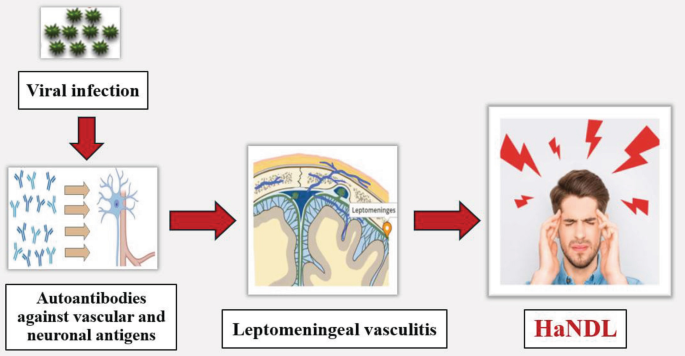 Headache with Neurological Deficits and CSF Lymphocytosis (HaNDL ...