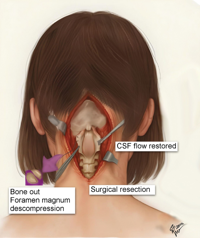 Headache Attributed to Chiari Malformation Type I (CM1) | Springer ...