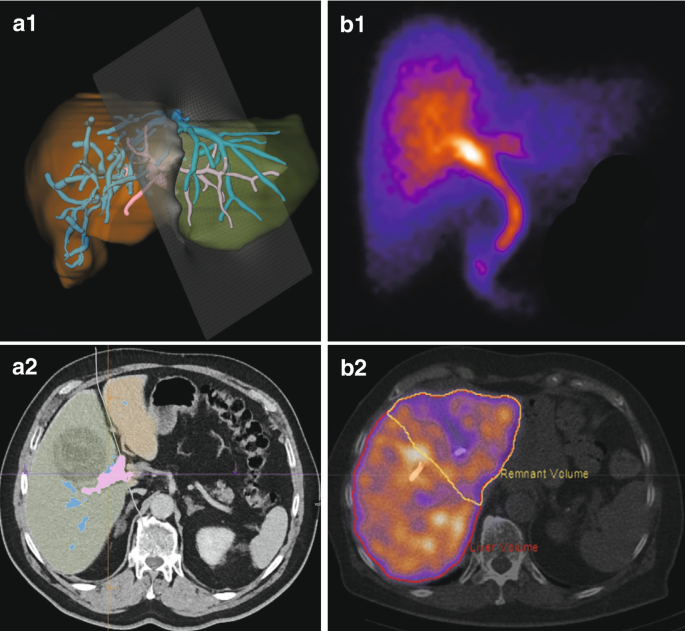 Functional Study of the Liver: Imaging Tests | Springer Nature Link