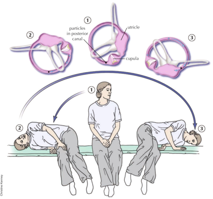 Dix Hallpike And Epley Maneuver A) Primary Position Of The Patient; B)