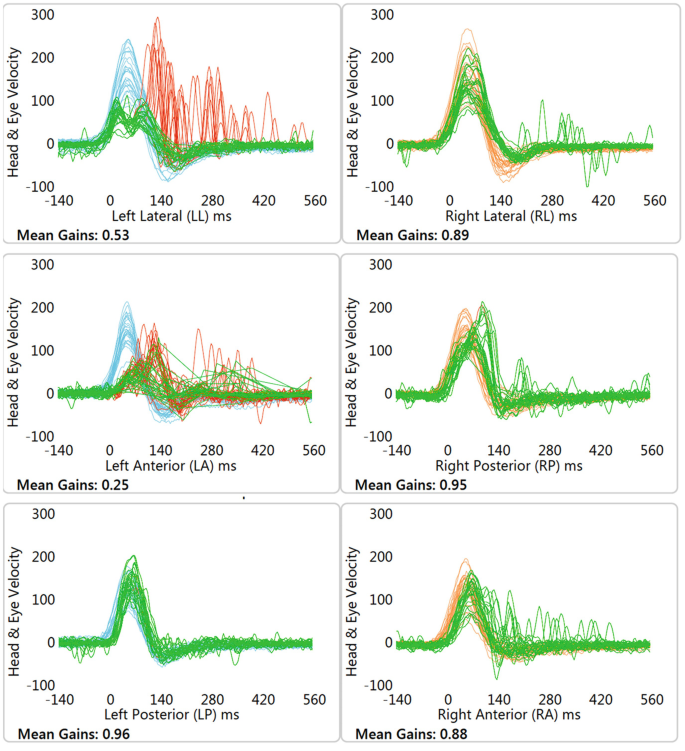 The Vestibulo-Ocular Reflex and Head Impulse Testing | Springer Nature Link