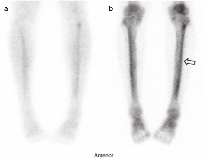 Nuclear Medicine in the Musculoskeletal System | Springer Nature Link