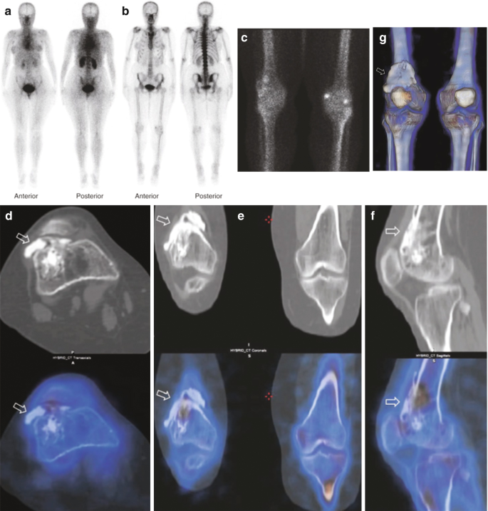 Nuclear Medicine in the Musculoskeletal System | Springer Nature Link