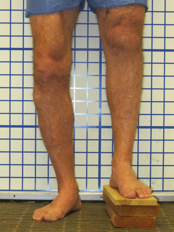 Post Oncologic Allograft Femur Nonunion Treated with Staged Compression ...