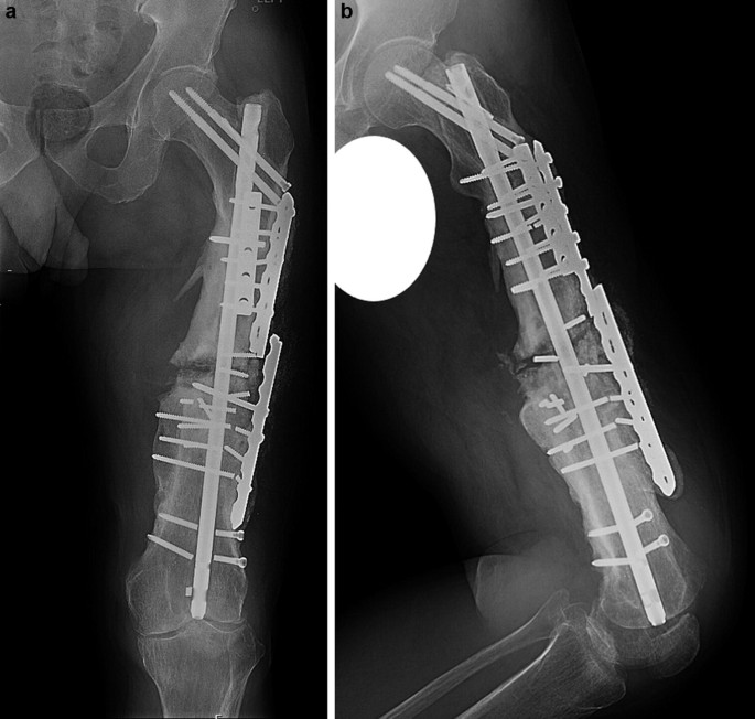 Post Oncologic Allograft Femur Nonunion Treated with Staged Compression ...
