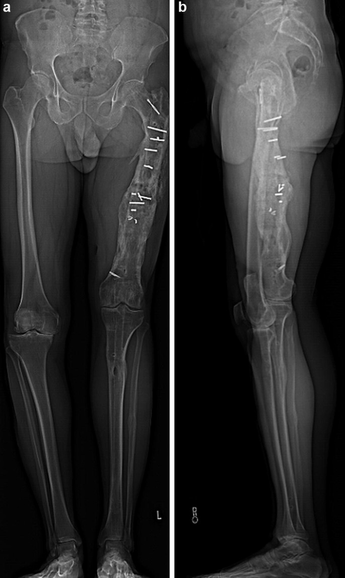 Post Oncologic Allograft Femur Nonunion Treated with Staged Compression ...