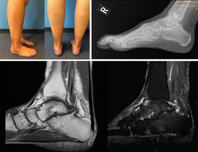 Subtalar Joint Distraction Arthroplasty | SpringerLink