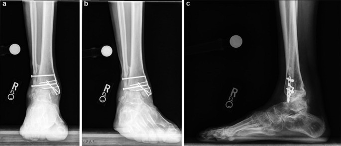 Fibula Lengthening and Ankle Distraction for Post-Traumatic Ankle ...