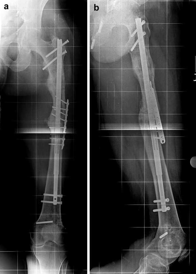 Repair of Femoral Nonunion with Acute Shortening and Concommitant ...